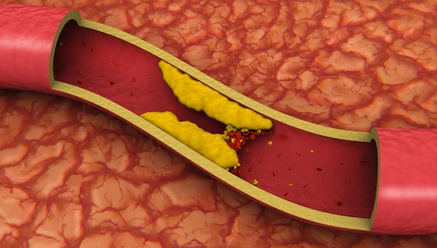 ANGIRX - STOP STROKE & HEART ATTACKS BEFORE THEY STOP YOU!